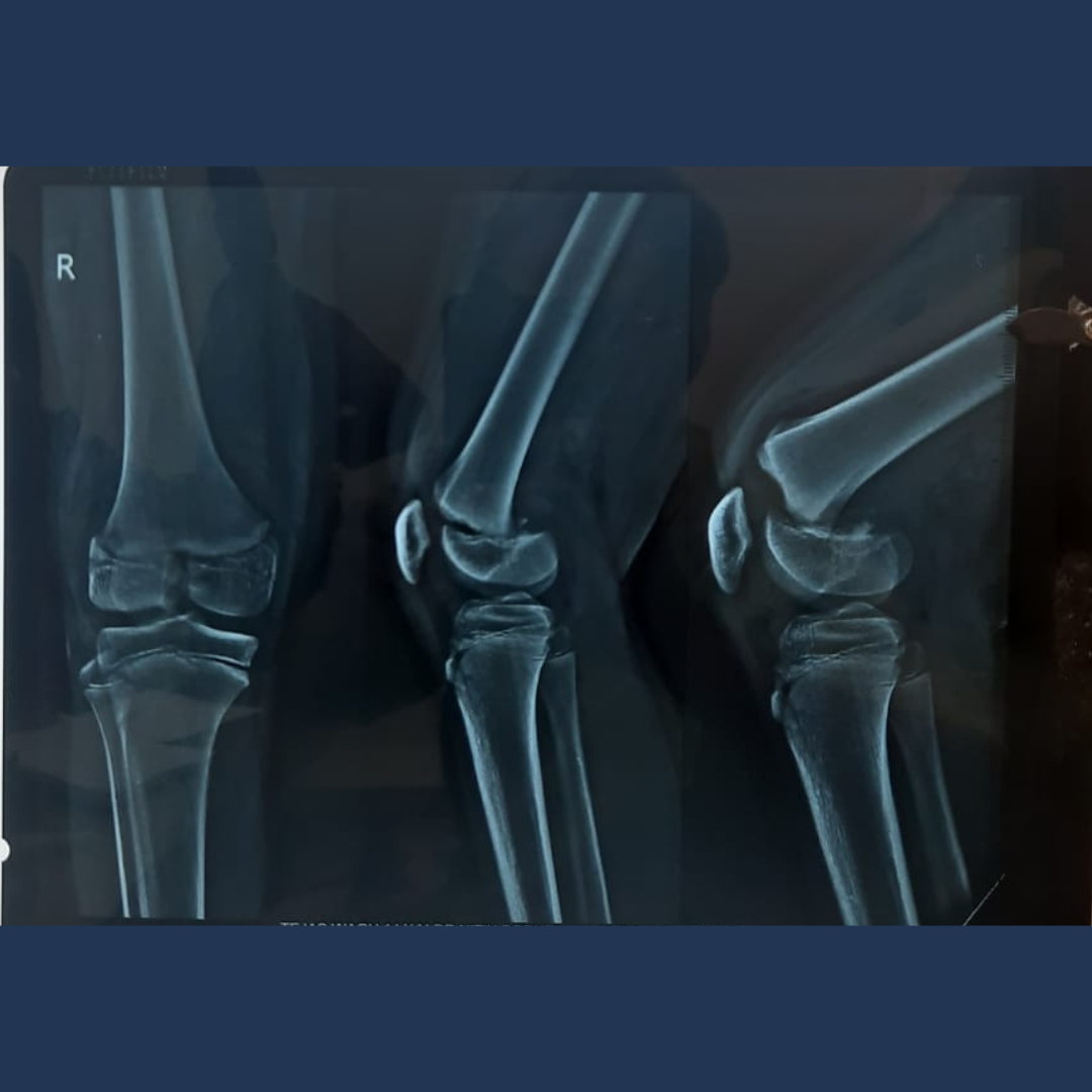 Limb Deformity - Sankalp Ortho Clinic