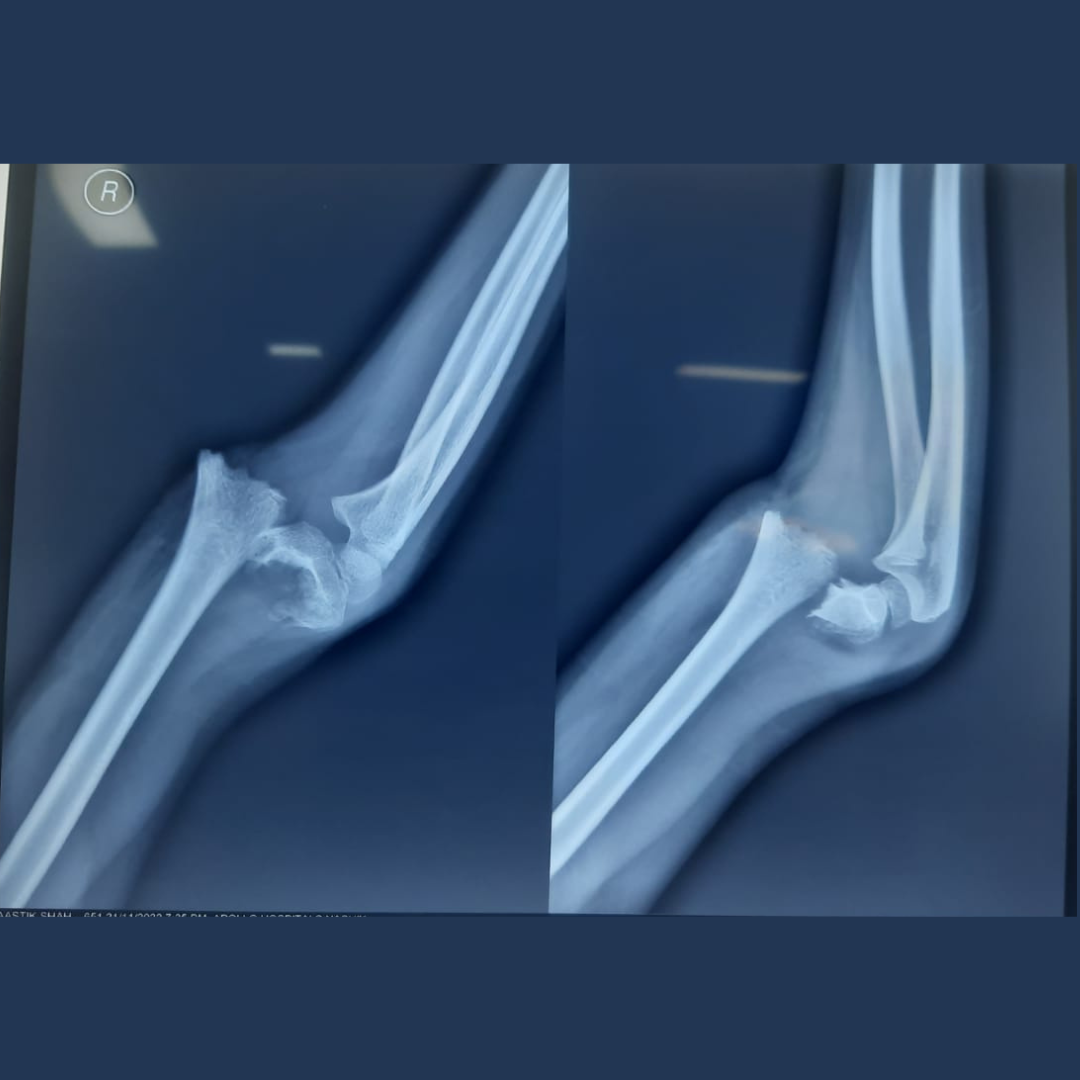 Limb Deformity - Sankalp Ortho Clinic