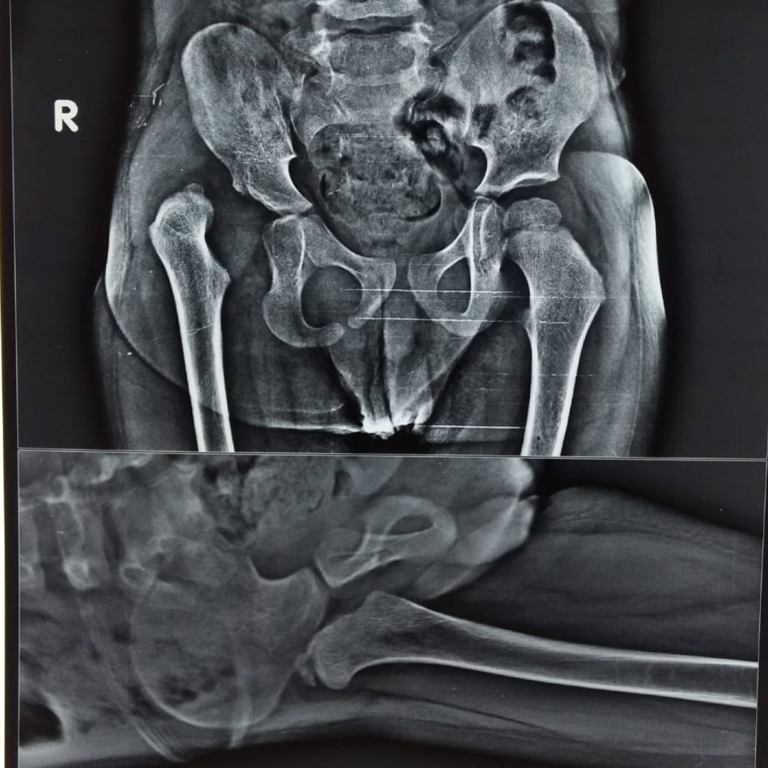 Development Dysplasia of hip - Sankalp Ortho Clinic